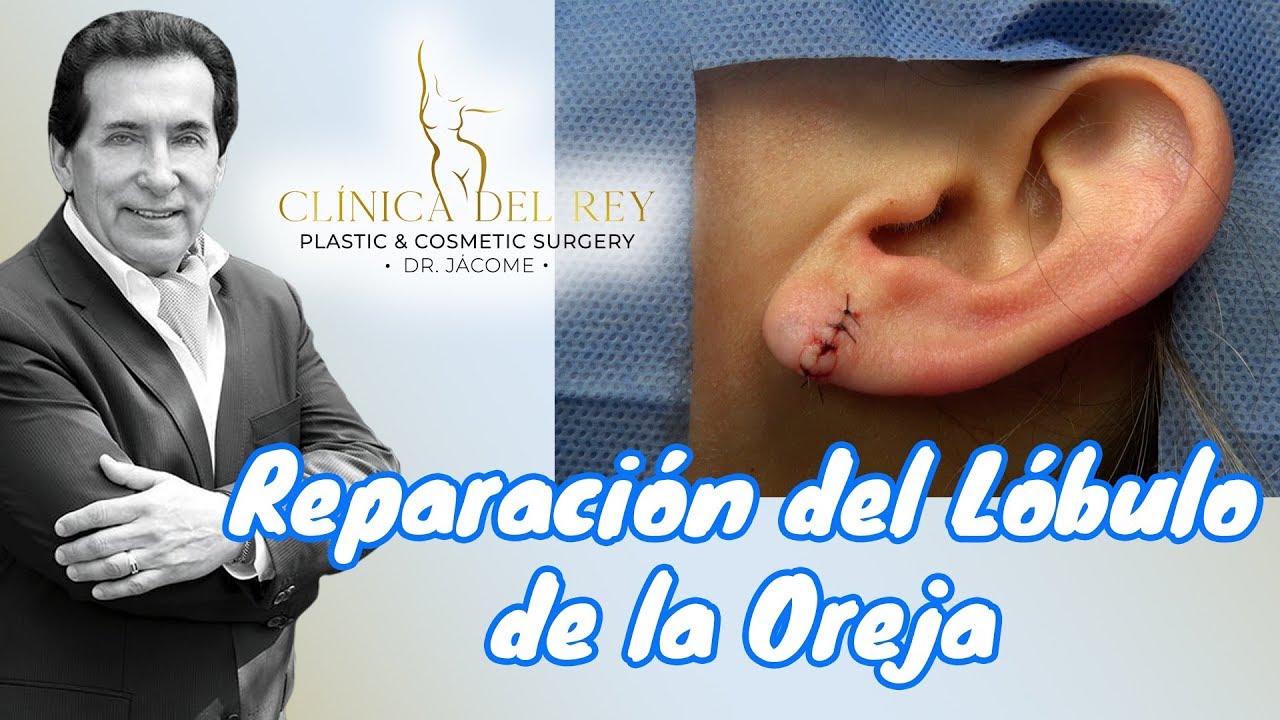 Cómo reparar el lobulo de la oreja rasgado 【2026 】 ️ Bricolaje